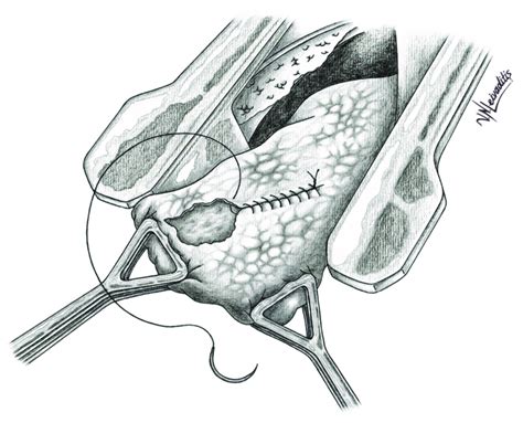 The Lung Metastasis Has Been Isolated From The Lung Parenchyma With An Download Scientific