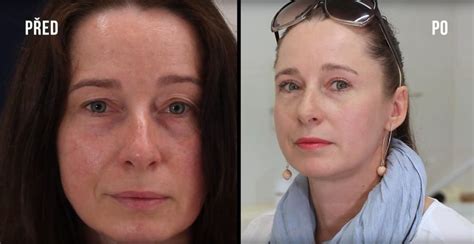 Video Jak Probíhá Operace Očních Víček Oslní Vás Rozdíl Před A Po