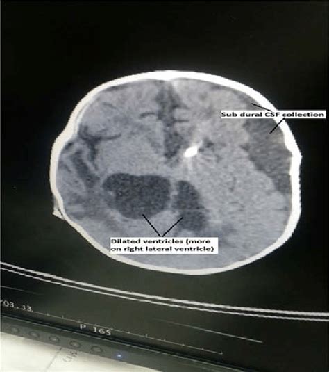 Ct Scan Of Head Showing Sub Dural Csf Collection At Left Side And
