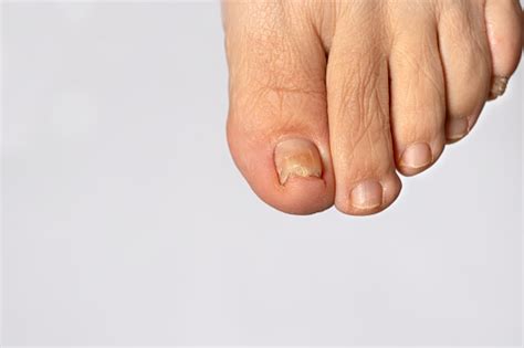 큰 발가락에 손톱의 곰팡이 피부과 오니초 마이코시스 곰팡이 감염 매크로 사진 자란 네일 플레이트 피부과 진균치료 건강 진단에