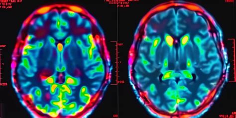 Mayo Clinic Unveils Ai Tool That Identifies Nine Types Of Dementia From