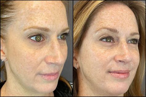 Patient 141788584 Lipoma Removal Before And After Photos Austin Face And Body