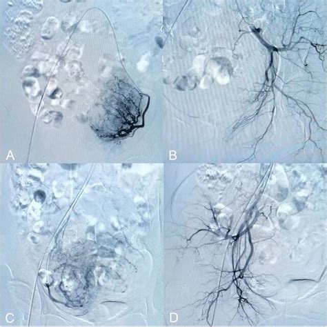 Comparison Of Angiography In Csp Patients Before And After Uae