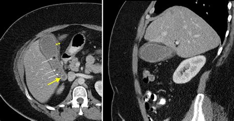 Acute Cholecystitis On Ct Radiology At St Vincents University Hospital