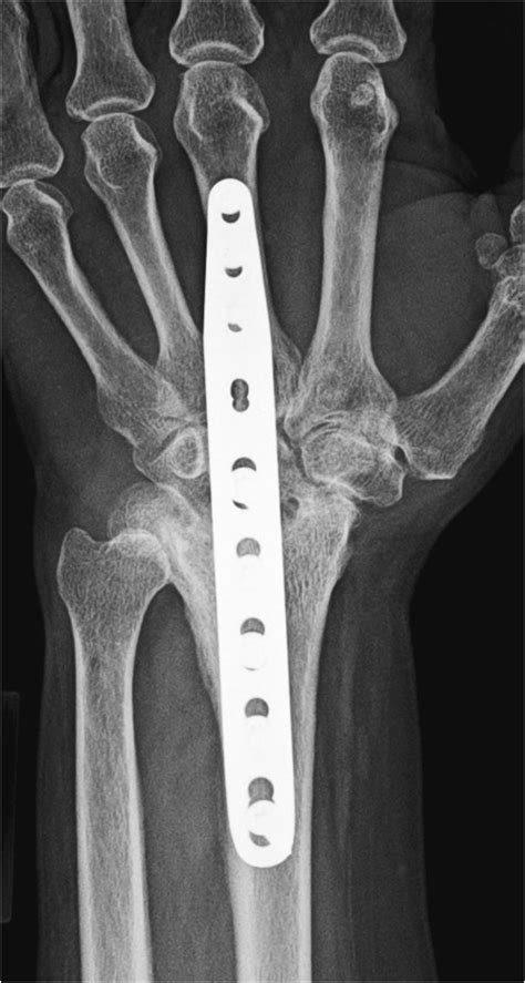 Complications Of Partial Wrist Fusion Musculoskeletal Key