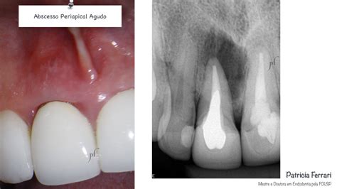 Fratura Radicular em dente pino metálico robusto Patricia Ferrari Endodontia