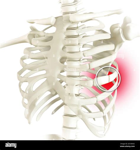 Costochondral Separation Costochondral Separation Diagnosis Things