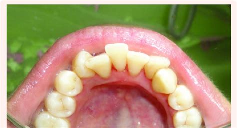 Postoperative Labial View Figure 6 Postoperative Lingual View