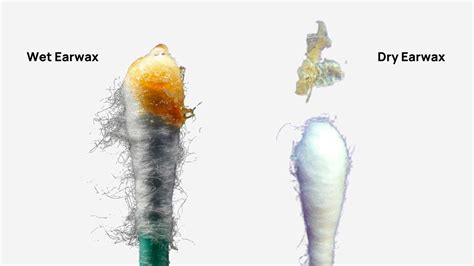 Earwax Color Meanings Wet Dry Orange Brown And More