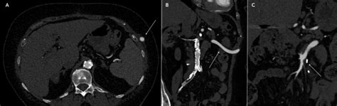 Axillary To Superior Mesenteric Artery Bypass As A Viable Solution For