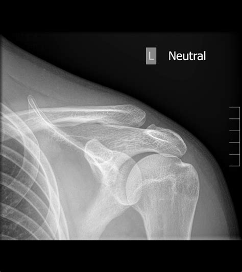 Mid Shaft Clavicle Fracture Sports Medicine Review