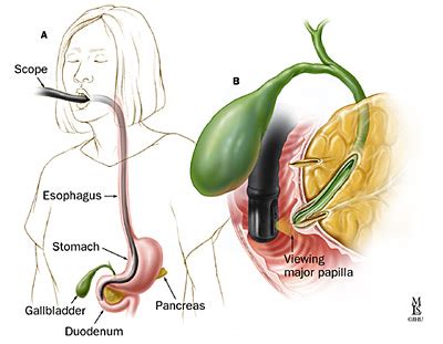Moonlight Memoirs ERCP Endoscopic Retrograde Cholangiopancreatography