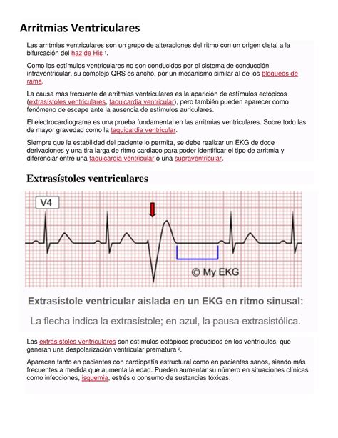 Arritmias Ventriculares Como los estímulos ventriculares no son