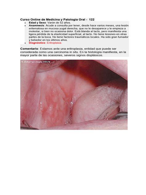 Casos De Eritoplasia Bucal Pdf Biopsia Medicina
