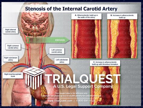 Progression Of Stenosis Internal Carotid Artery Trialexhibits Inc
