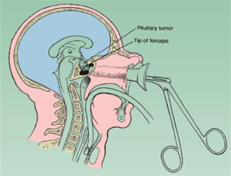 Transsphenoidal Hypophysectomy Flashcards Quizlet
