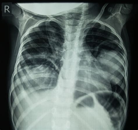 A Case Of Multiple Giant Primary Bilateral Lung Hydatid Cysts In A Very