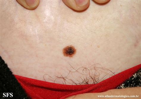 Dysplastic Nevus Nc Commons