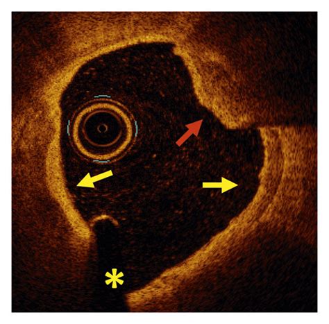 Case 6 Eruptive Calcific Nodule With Plaque Rupture A Coronary