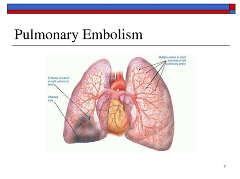 Ppt Pulmonary Embolism Aortic Aneurysm Aortic Dissection Powerpoint