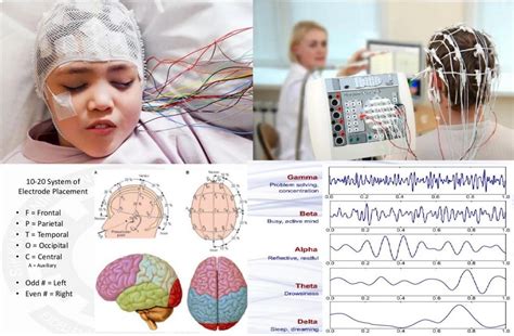 Electroencefalograma EEG Neurologie Pediatrica
