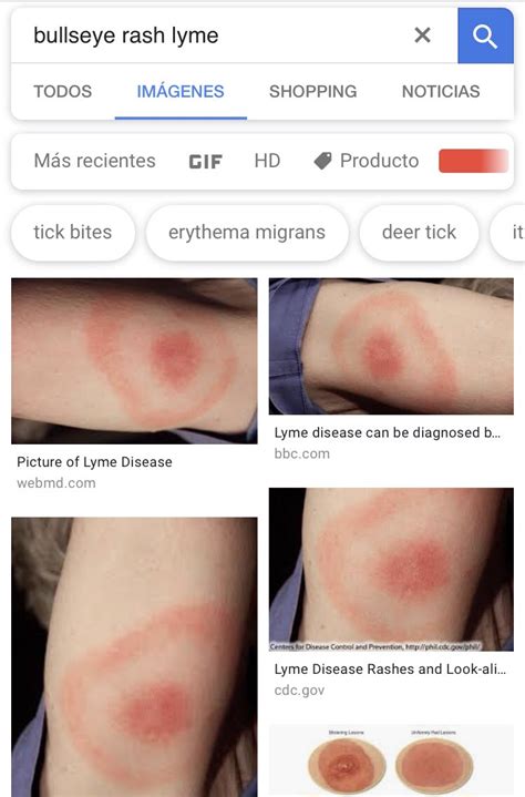 Does A Bullseye Rash Mean Lyme Disease Captions Profile