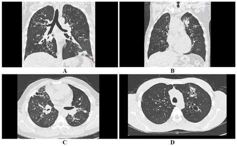 Revisiting Hrct Features Of Abpa