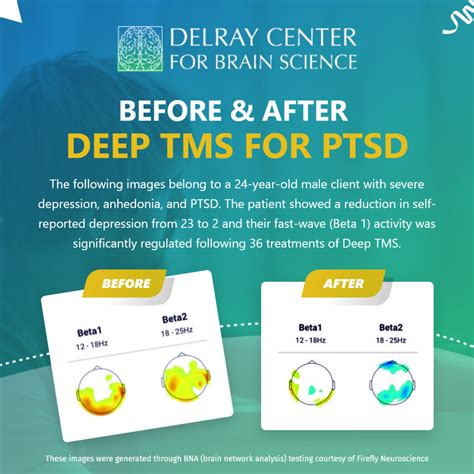 Tms Resuls Delray Brain Science