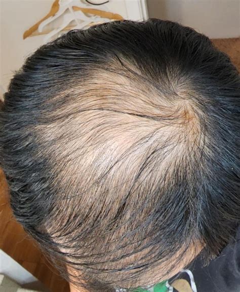 Oral Minoxidil Beard Eyebrows R Tressless