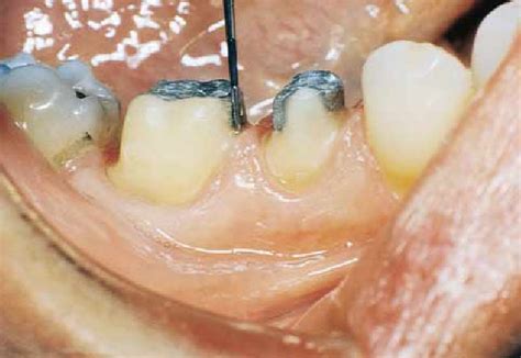Tooth Crown Preparation