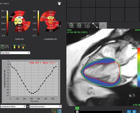 Post Processing Of Radial And Longitudinal Strain Measurements Is