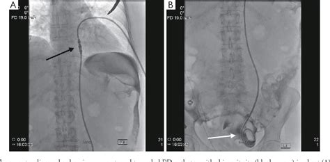 Figure 1 From Image Guided Tunneled Peritoneal Dialysis Catheter