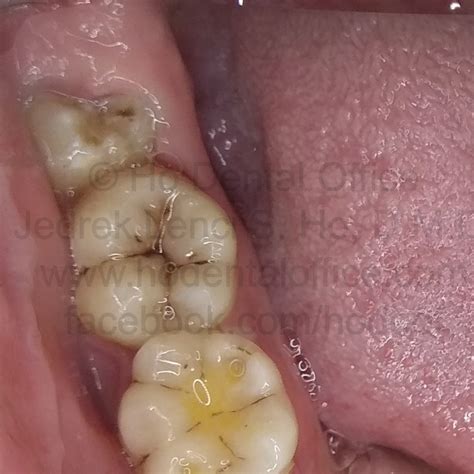 Operculectomy Dental Circumcision Ho Dental Office Dentist Binondo Manila Philippines