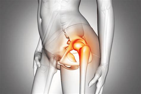 Congenital Hip Dislocation Ishaan Ortho And Spine Clinic Bangalore