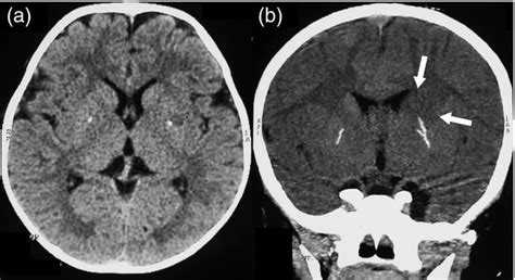 Lenticulostriate Arteries Stroke