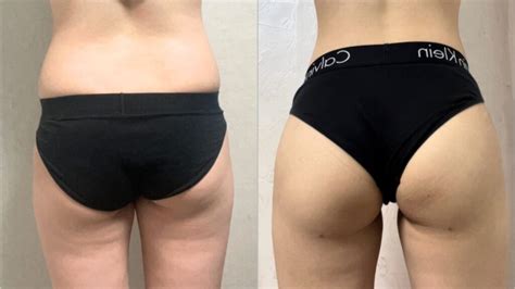 Buttock Surgery 365 Plastic Surgery Korea