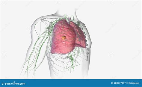 In Stage 2a Lung Cancer The Tumor Measures Between 4 Cm And 5 Cm And
