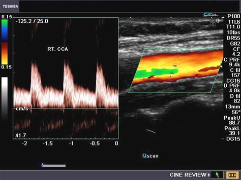 Radiologyspirit Spectral Doppler Waveform Of The Normal Common Carotid
