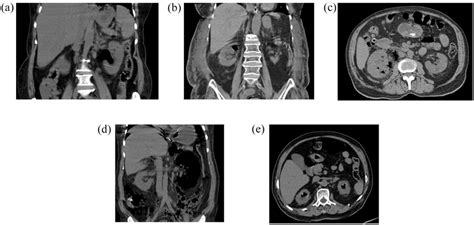 Emphysematous Pyelonephritis