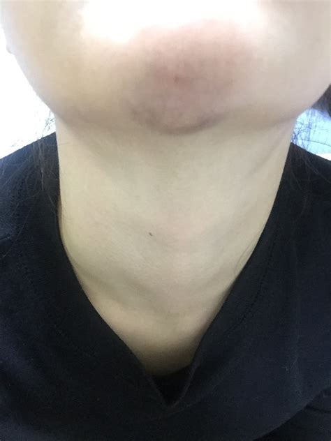 시술수술 질문 턱끝필러 멍 3일째 강남언니 1등 성형수술and피부시술 정보앱