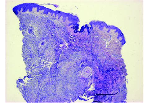 Histopathology Of Leiomyosarcoma 20· Hande Stain Download