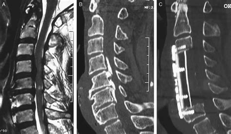 A C Representative Radiographs Of The Corpectomy Group The Corpectomy