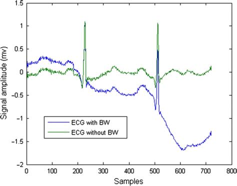Baseline Wander Removal Of Electrocardiogram Signals Using Multivariate Empirical Mode