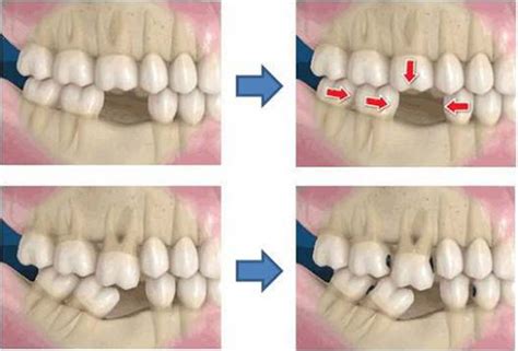 ¿quÉ Consecuencias Tiene La Falta De Dientes