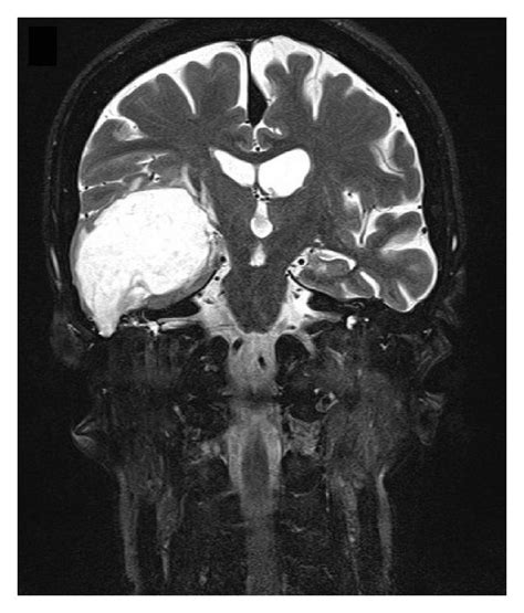 A T2 Weighted Mri Axial Image Demonstrates A Smooth Bordered