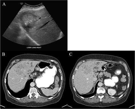 Multidisciplinary Management In The Treatment Of Intrahepatic