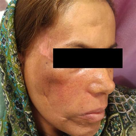 Carcinoma Adenoide Cistico Scarsamente Differenziato Infiltrante Tutto