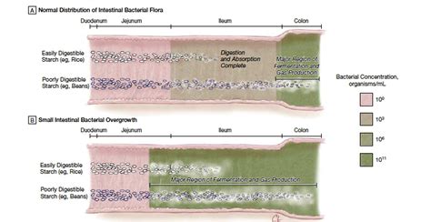 An Understanding Of Sibo And Sifo Part 1 El Paso Tx Sciatica Pain
