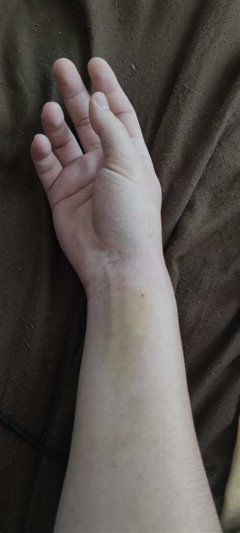 3 Days Post Coronary Angiogram Can Barely Use Bend My Arm Hand Without