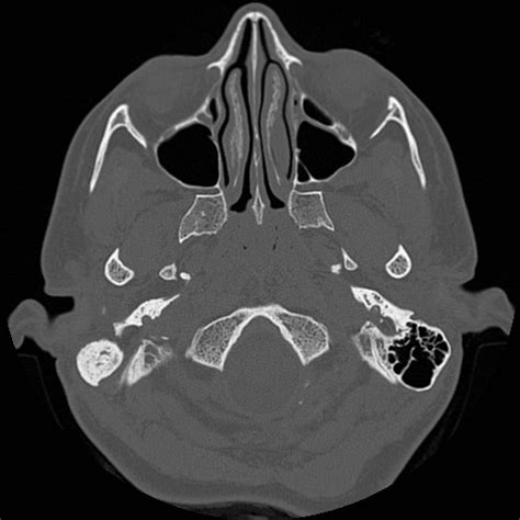 Chronic Otomastoiditis Radiopaedia 27138 27309 Axial Bone Window Nc